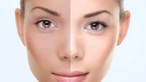 Benefits of Skin Lightening Treatment | Dr. Rinky Kapoor
