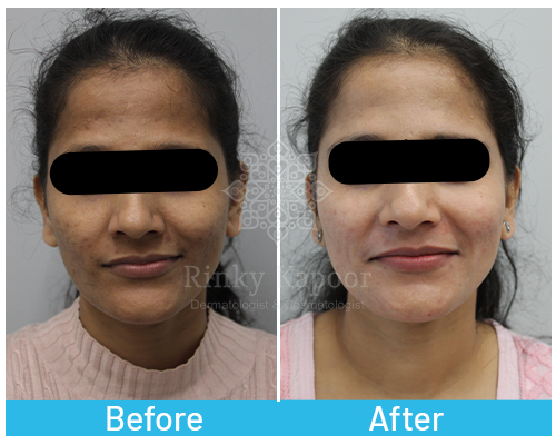Esthetic Face Brite™ | Advanced Skin Brightening Treatment